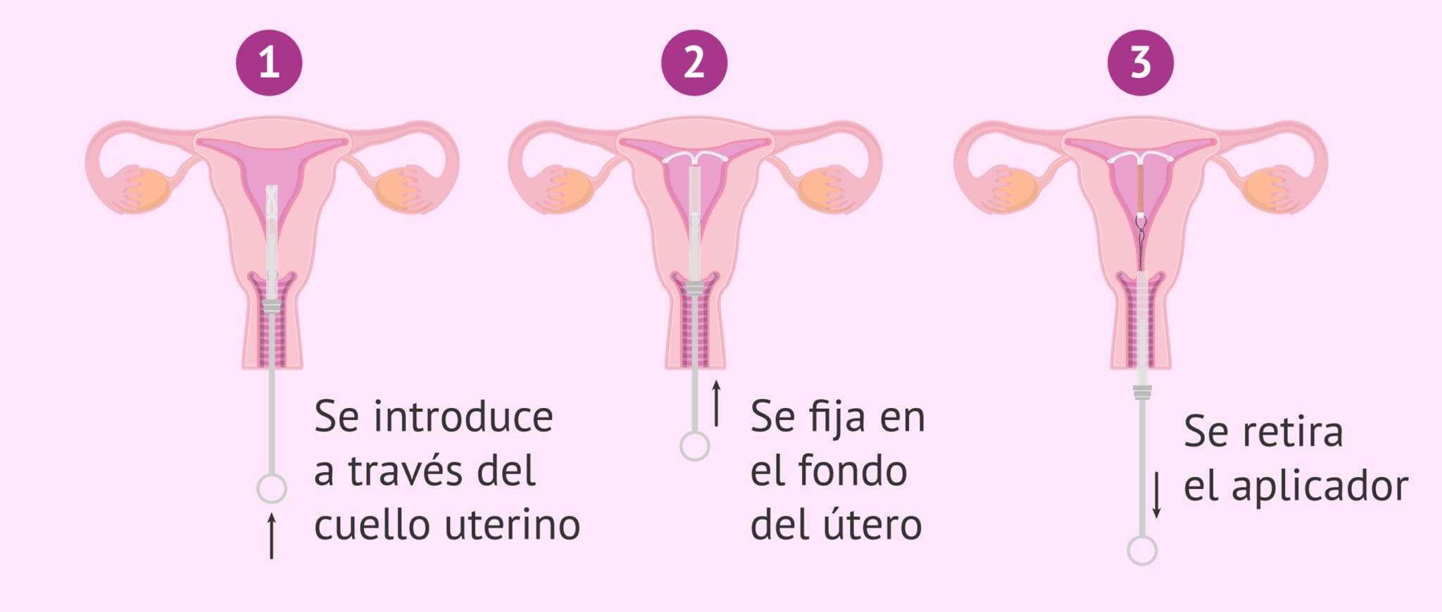 Cuánto cuesta el diu Mirena?】
