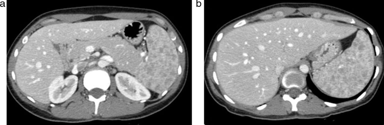 Cuánto mide el bazo?】