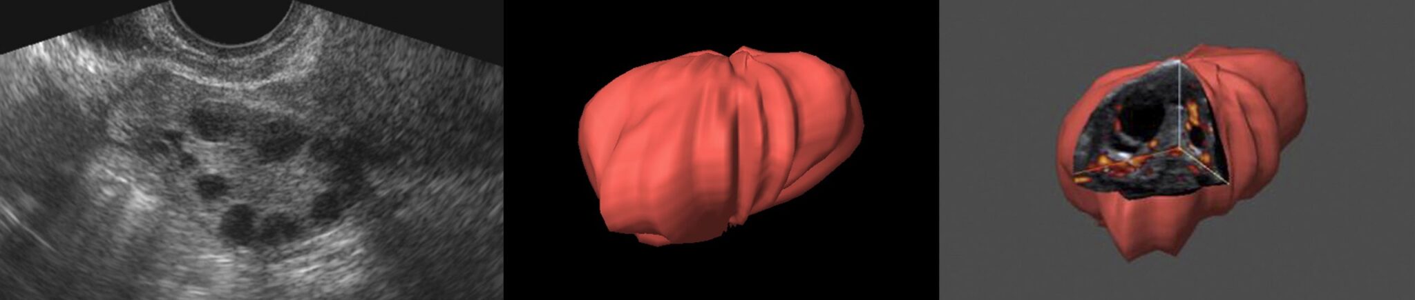 Cuánto mide un ovario normal?】