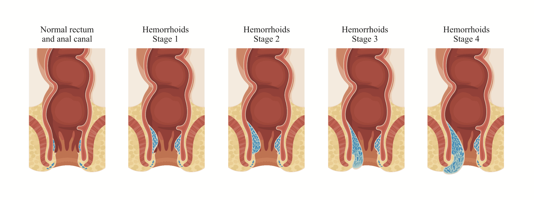 Cuánto se dilata el ano?】